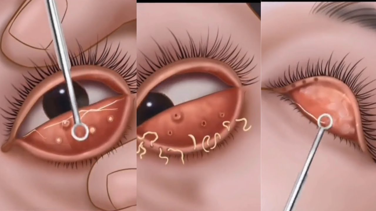 Eye stone removal asmr and face maggot. Removal - YouTube