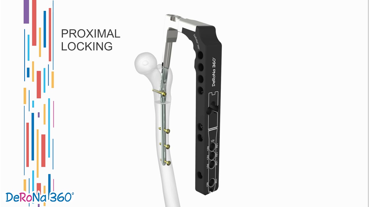 PediTST DeRoNa 360 Surgical Technique Animation - YouTube