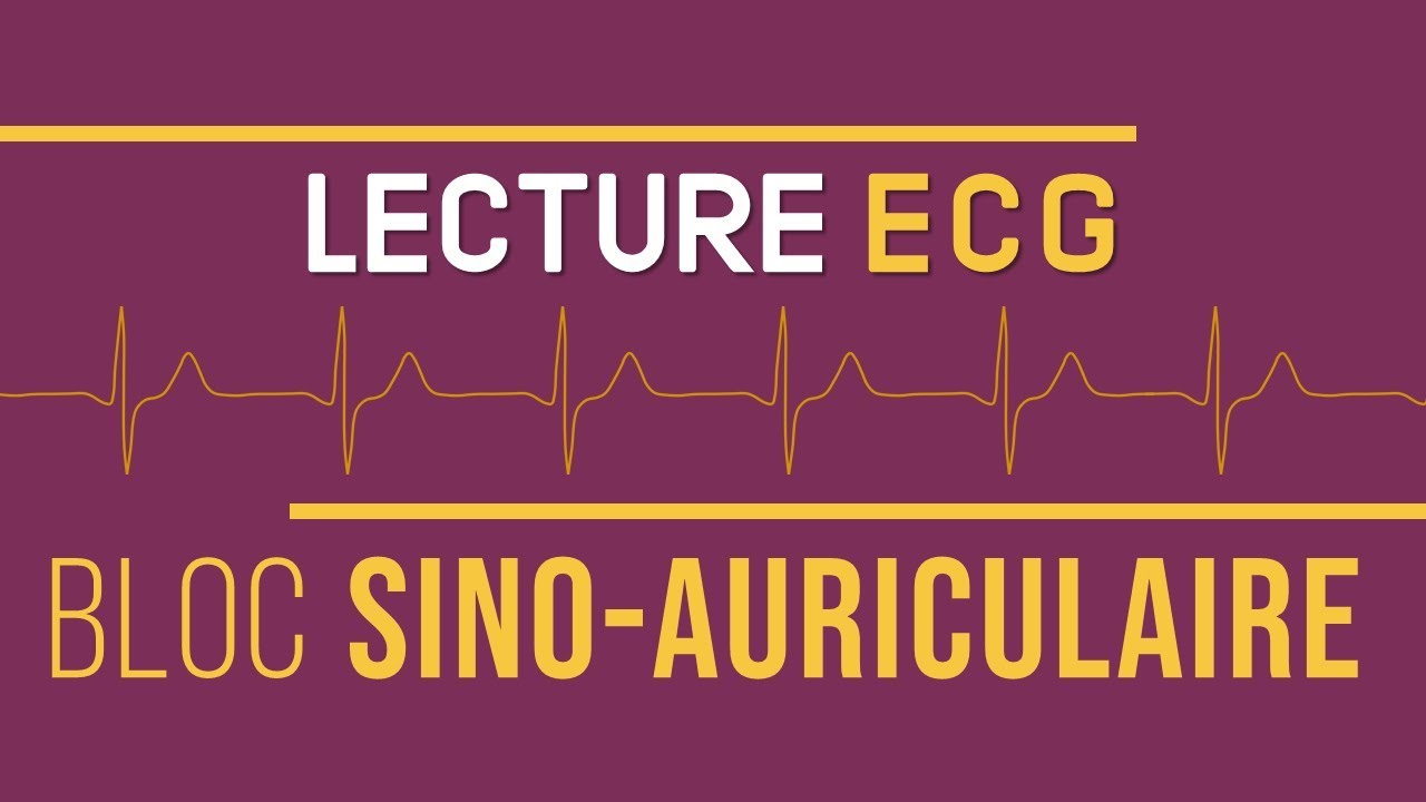 Interprétation ECG - Bloc Sino-Auriculaire - YouTube