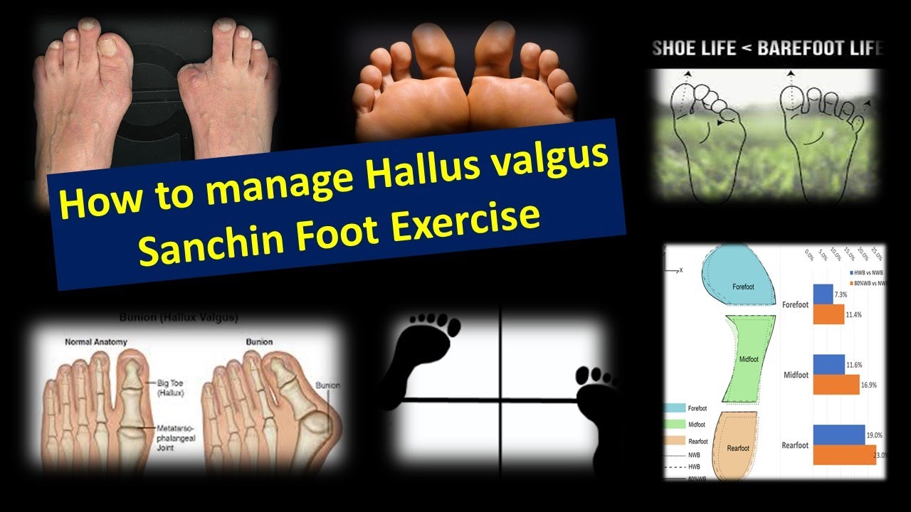 Hallus valgus | Save your feet with Sanchin Foot Exercise | Dr S ...