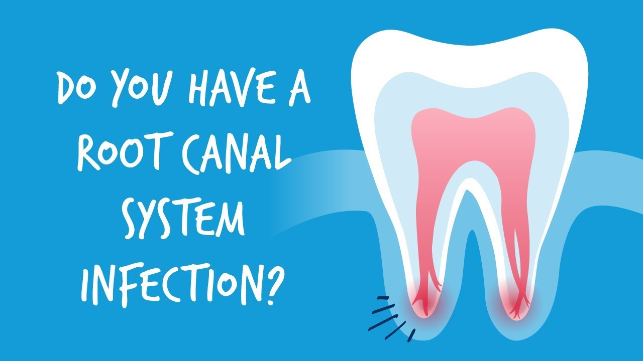 Do You Have A Root Canal System Infection YouTube