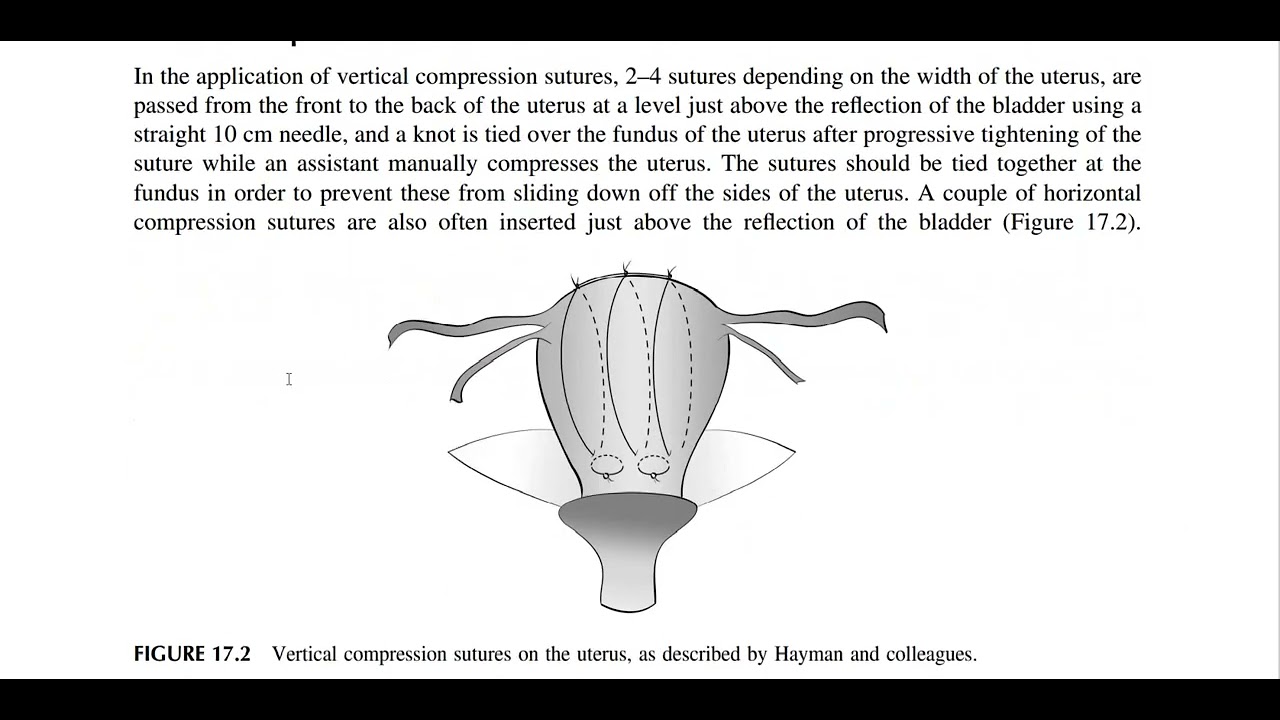 uterine compression sutures - YouTube