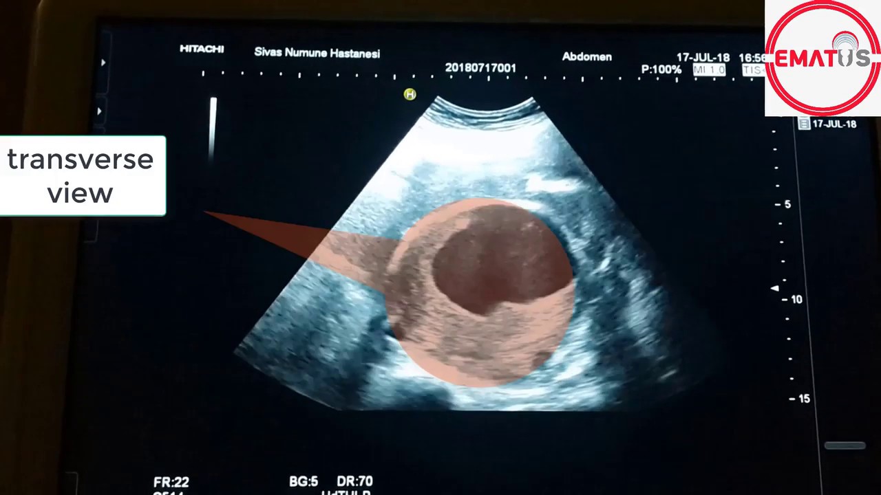 Ruptured Abdominal Aortic Aneurysm YouTube
