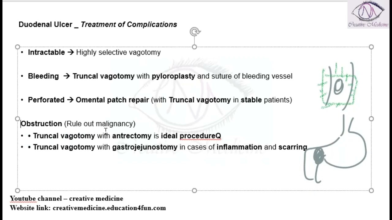 Vagotomy And Antrectomy