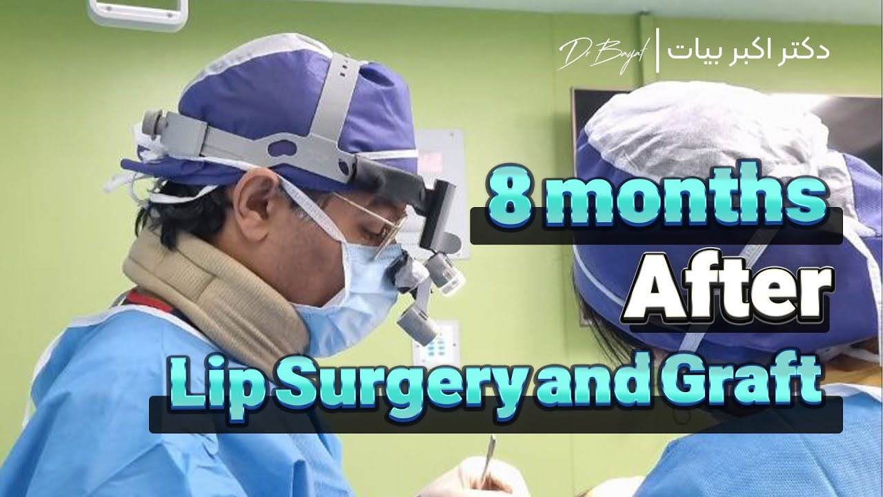 8 months After Lip Surgery with Graft | Dr. Akbar bayat - YouTube