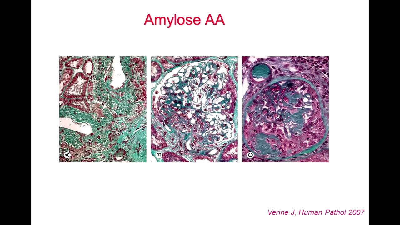 Atteinte_rénale_dans_l'amylose_de_la_physiopathologie_à_la_clinique ...