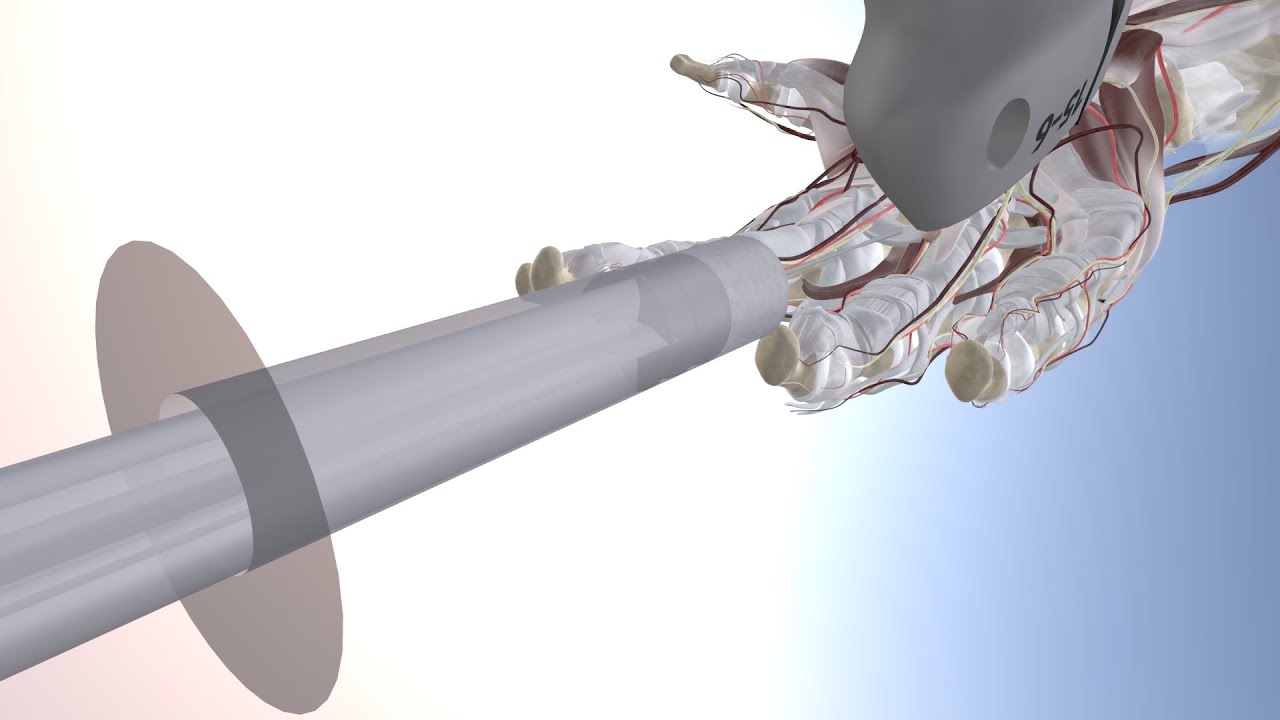 Ultrasound Guided Trigger Finger Injection over Presumed Ganglions near ...