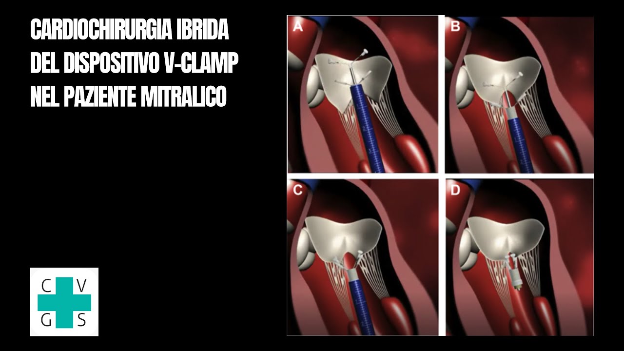 V clamp Team Cardio Gran Sasso - YouTube