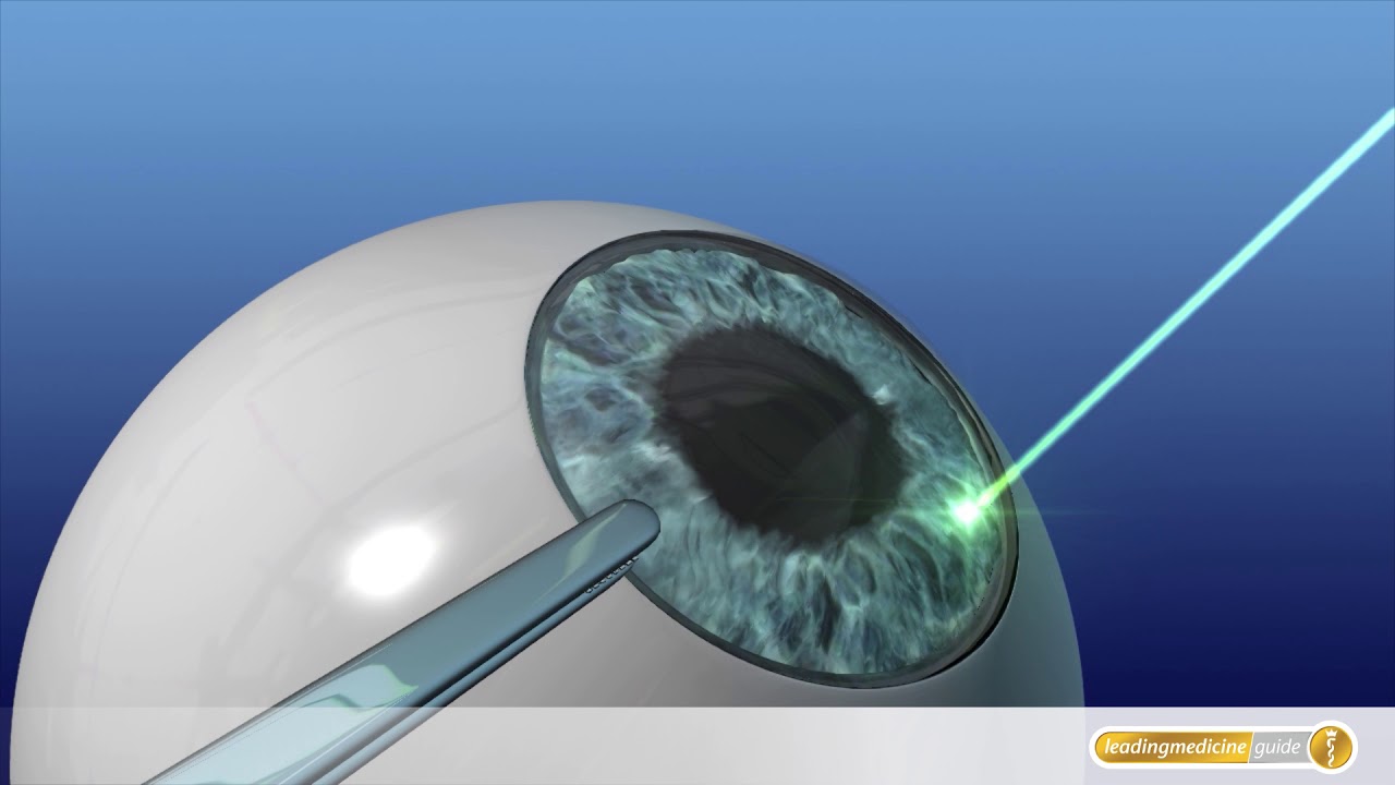 Augen-OP mit Laser: So funktioniert LASIK - YouTube