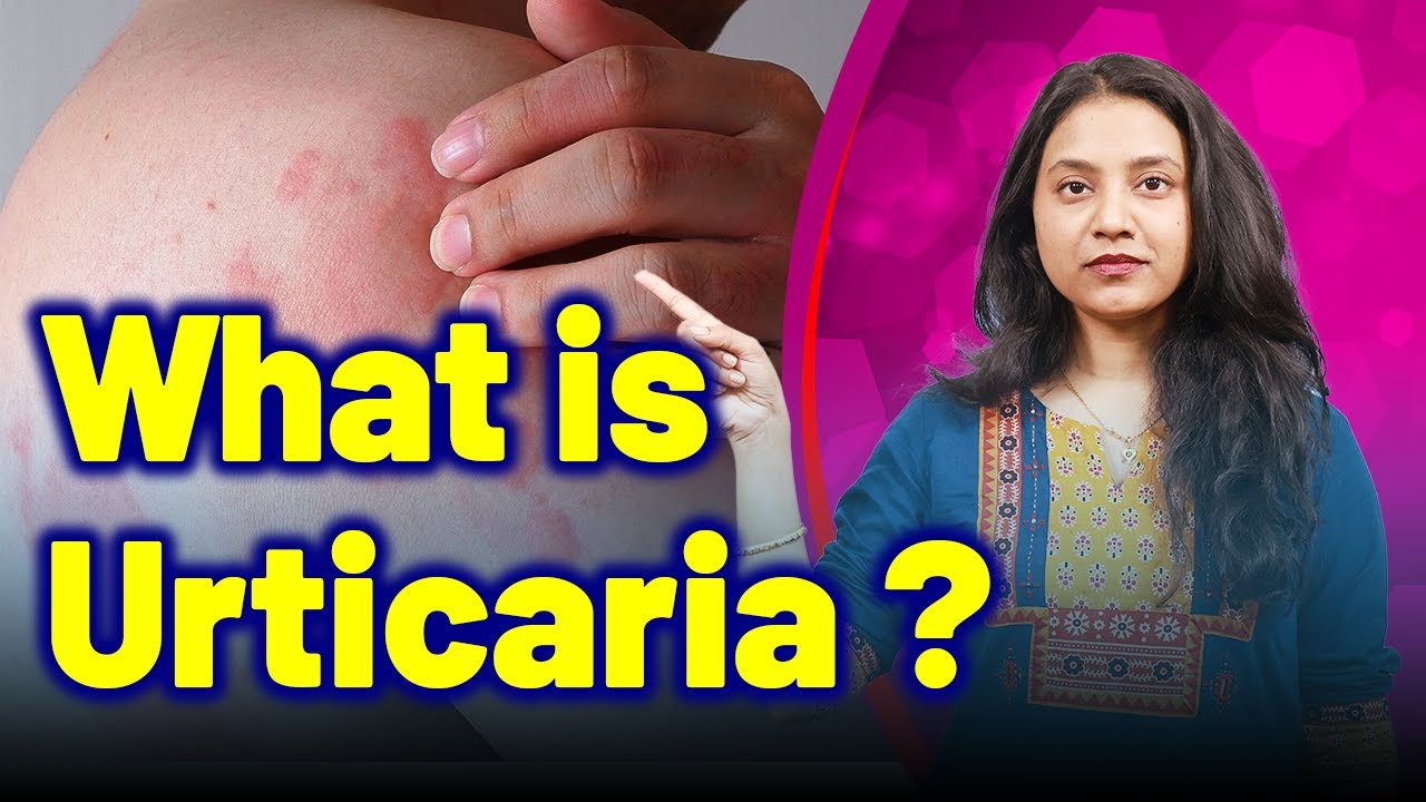 What is Urticaria, Nettle rash, Hives, Wheals. | Treatment Cure Relief ...