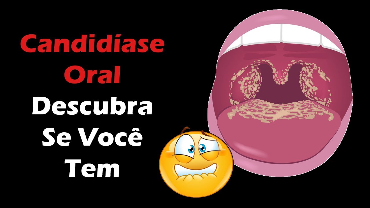Candidíase Na Boca - Descubra O Que é, As Causas e Qual o Tratamento ...