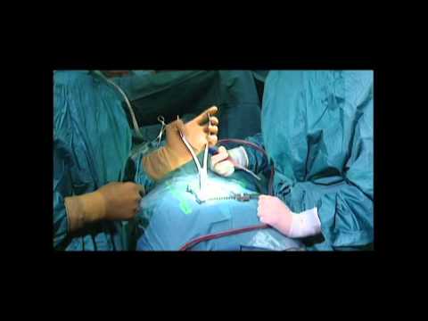 COFLEX F português - YouTube