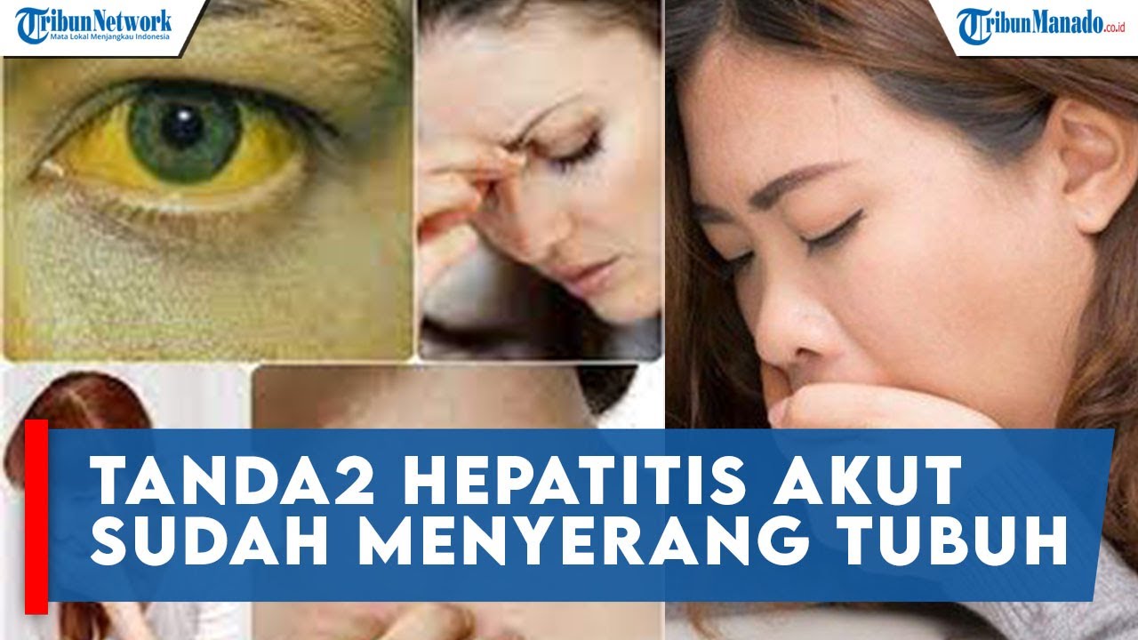 Tanda-tanda Hepatitis Akut Sudah Menyerang Tubuh, Ini Gejalanya, Segera ...