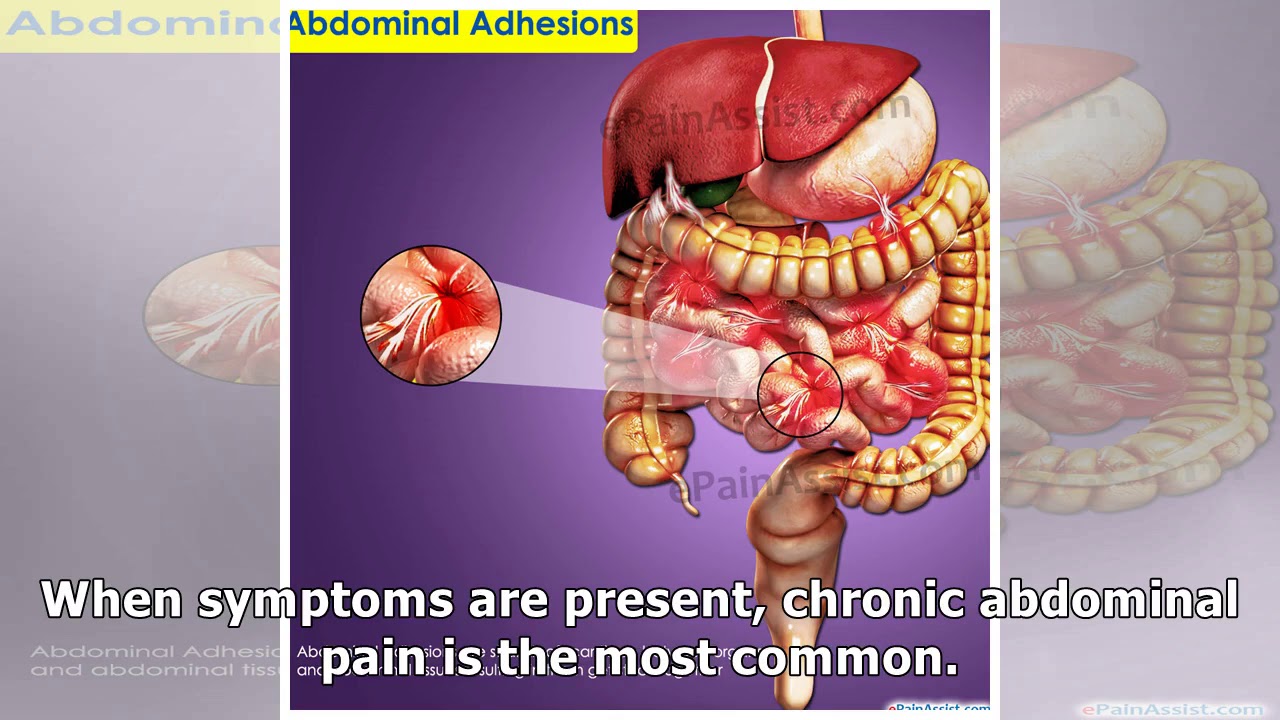 Abdominal Adhesions | NIDDK - YouTube