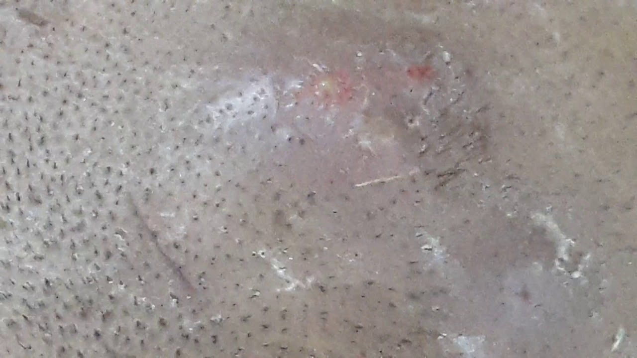 Furunculosis scalp+Post inflammatory hyperpigmentation patches - YouTube