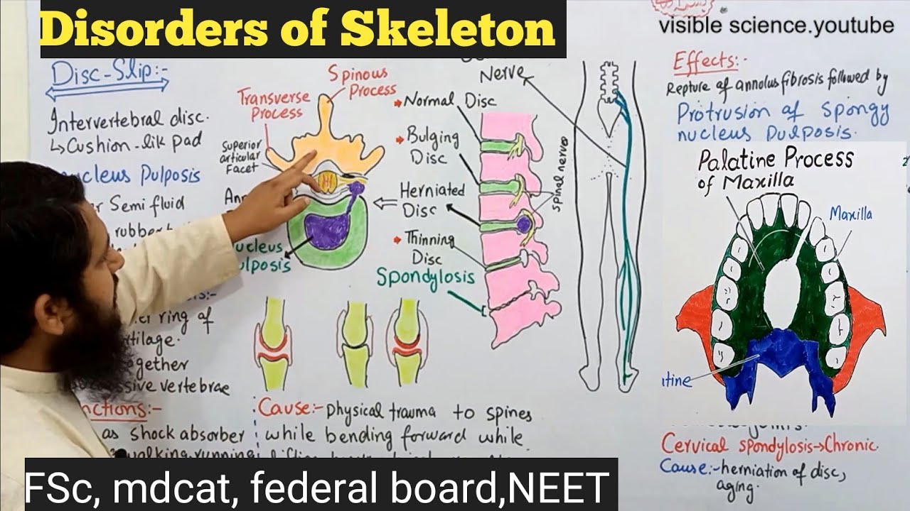 deformities of skeleton class 12 | disorders of human skeleton class 12 ...