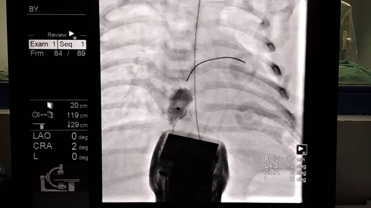 Balloon Atrial Septostomy (BAS) - YouTube