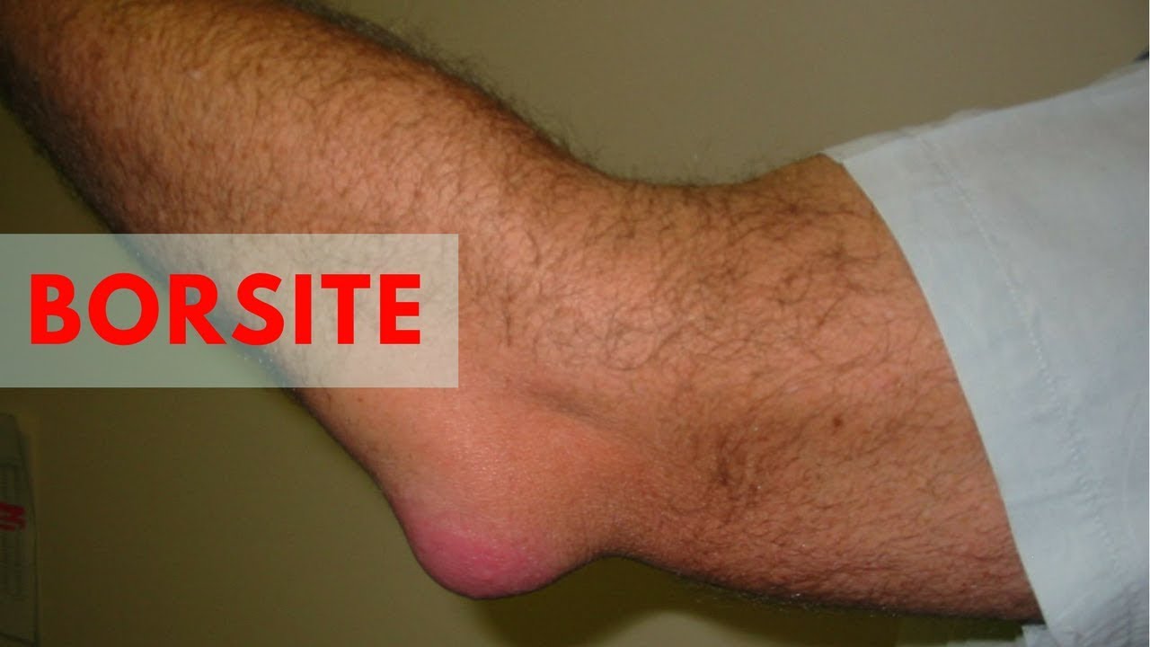 Sintomi, Cause e Rimedi per la Borsite | Pronto Soccorso Naturale - YouTube