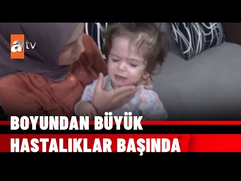 Minik Eylül yardım bekliyor  - atv Haber 6 Nisan 2022