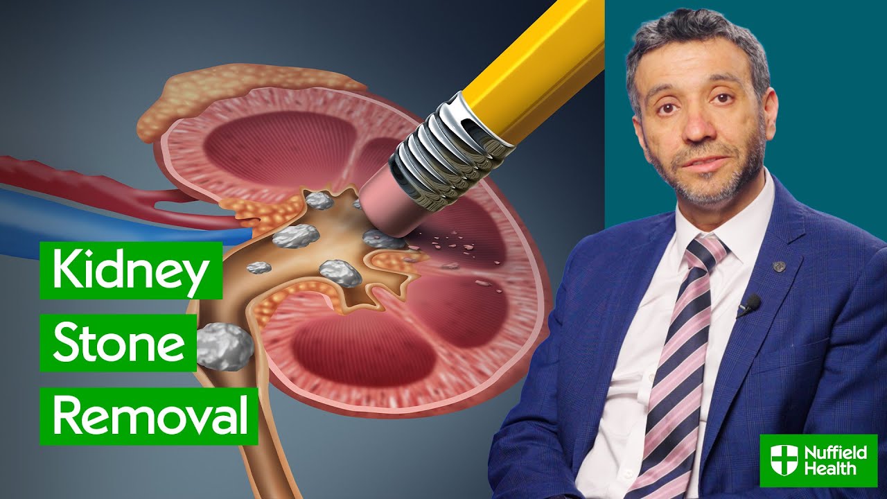 Kidney Stone Removal Options | Lithotripsy, Ureteroscopy & PCNL ...