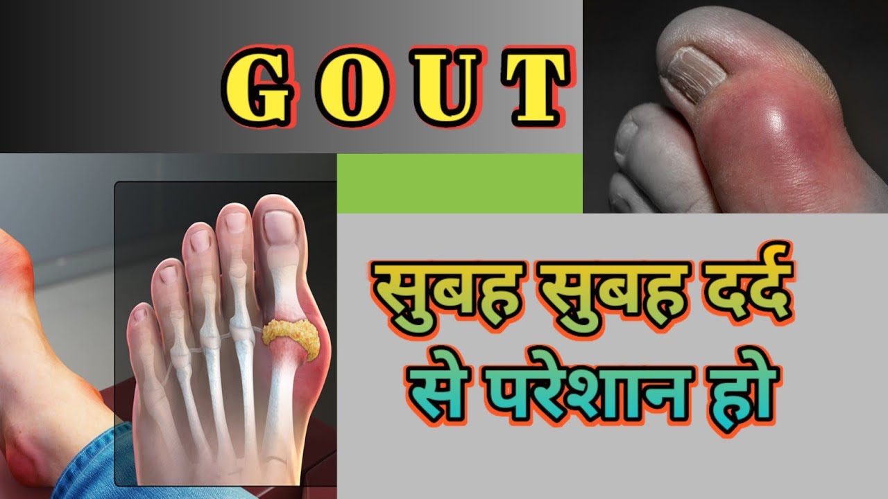 Gout cause and Symptoms। Gout attack । Uric acid and Gout । Om Homoeo ...