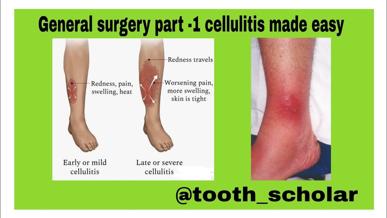 "Cellulitis Made Easy: Simplified Guide for Easy BDS Scoring" - YouTube