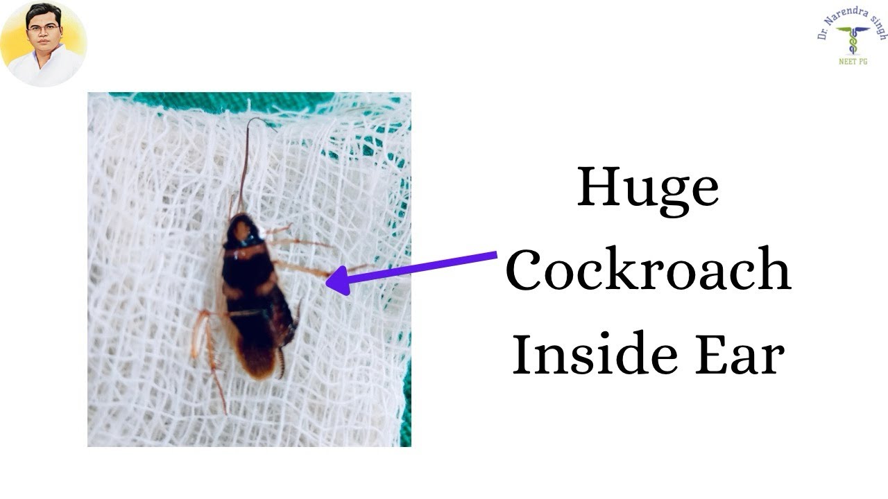 Huge Cockroach Inside Ear/ Ear Got Blocked by Dead Insect - YouTube