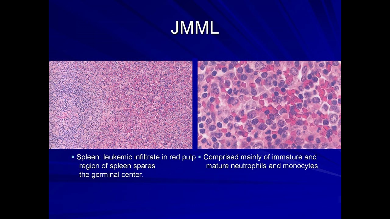 2 2 juvenile myelomonocytic leukaemia myelodysplastic syndrome JMML MDS ...