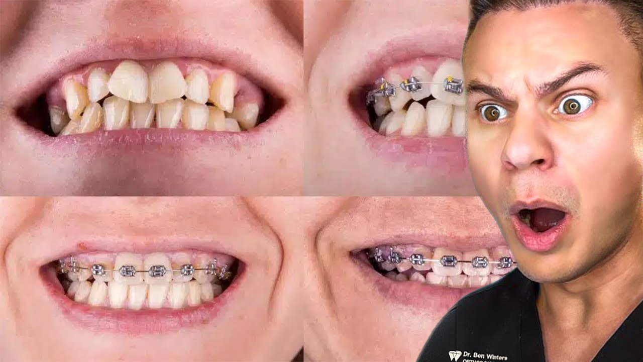 The WEIRD Reason Braces Can Fix ANY Smile! - YouTube