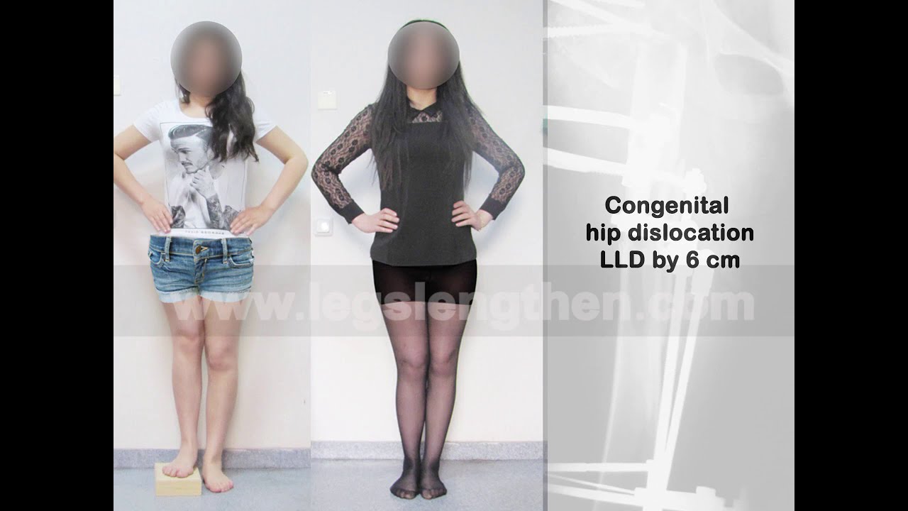Congenital hip dislocation, leg length discrepancy (LLD) 6 cm - YouTube