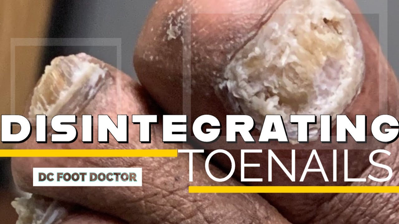 Disintegrating Toenails: Advanced Fungal Toenail Infection - YouTube