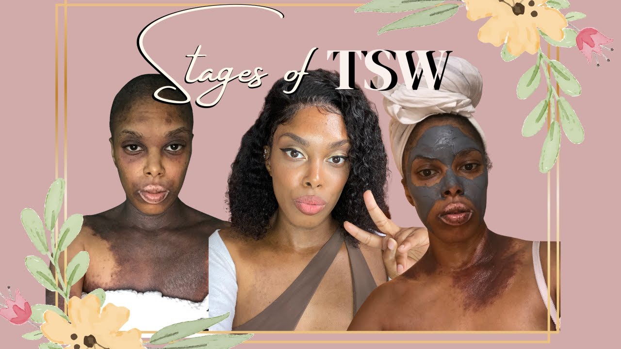 The stages of TSW | Topical Steroid Withdrawal - YouTube