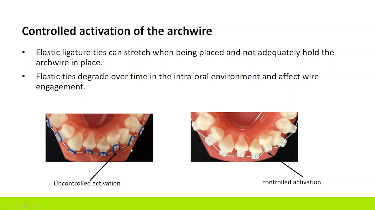Engaging with Self-Ligation: Archwire activation in self-ligation - YouTube
