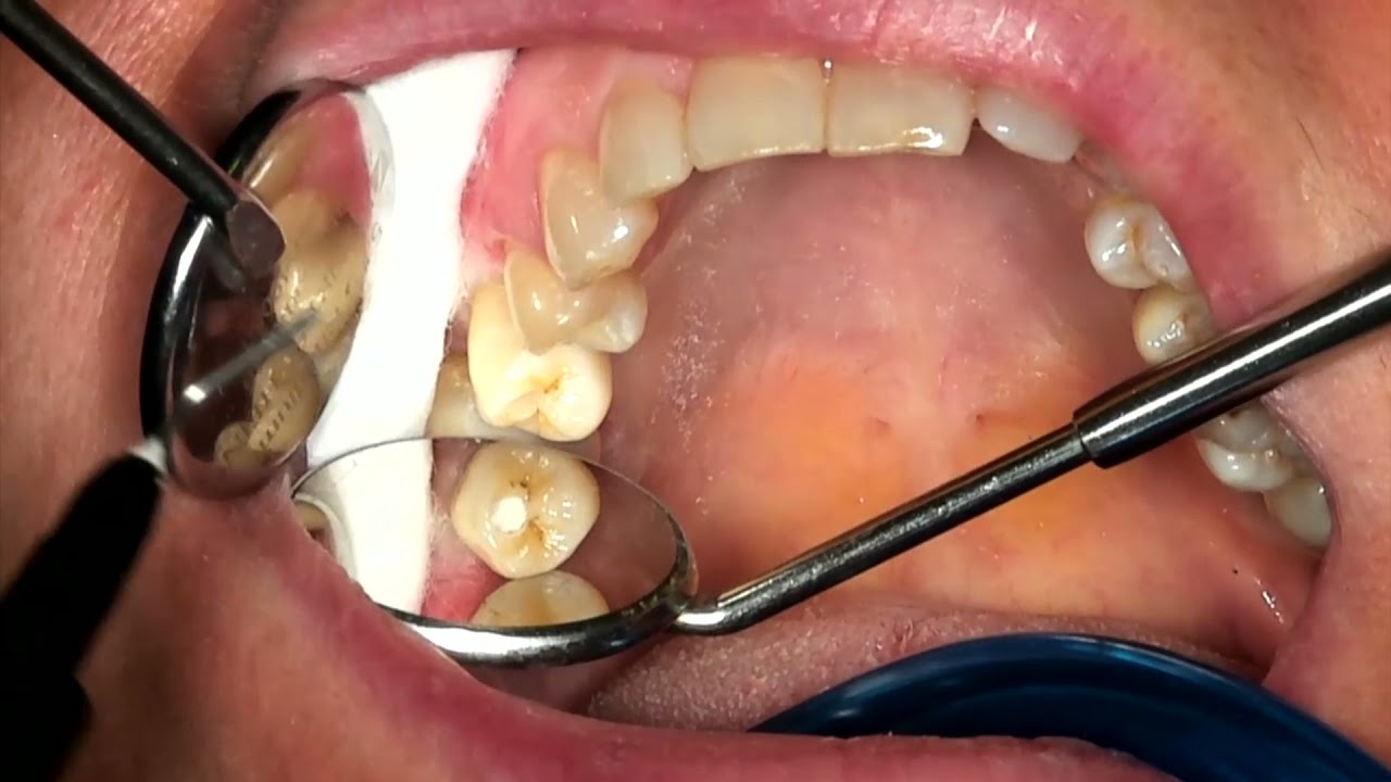 Screw retained implant supported crown delivery - YouTube