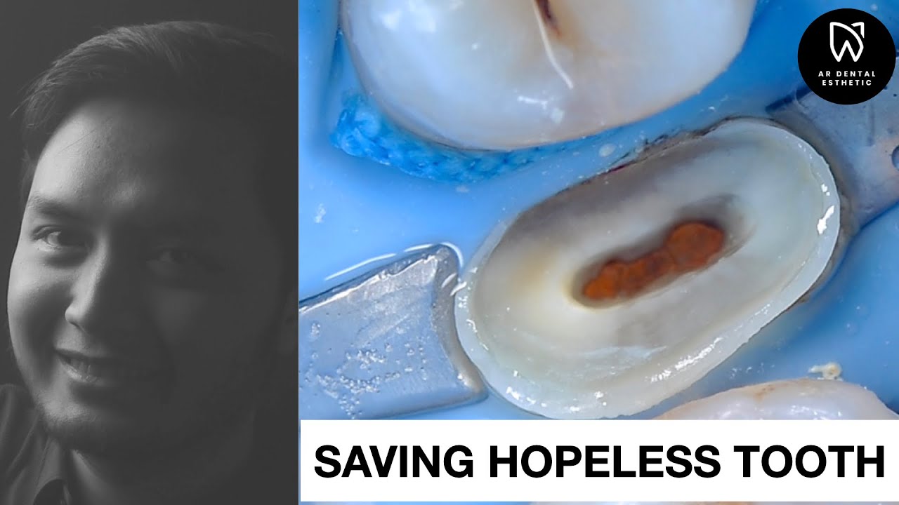 SAVING HOPELESS TOOTH | DENTIST | DR RIZAL RIZKY AKBAR - YouTube
