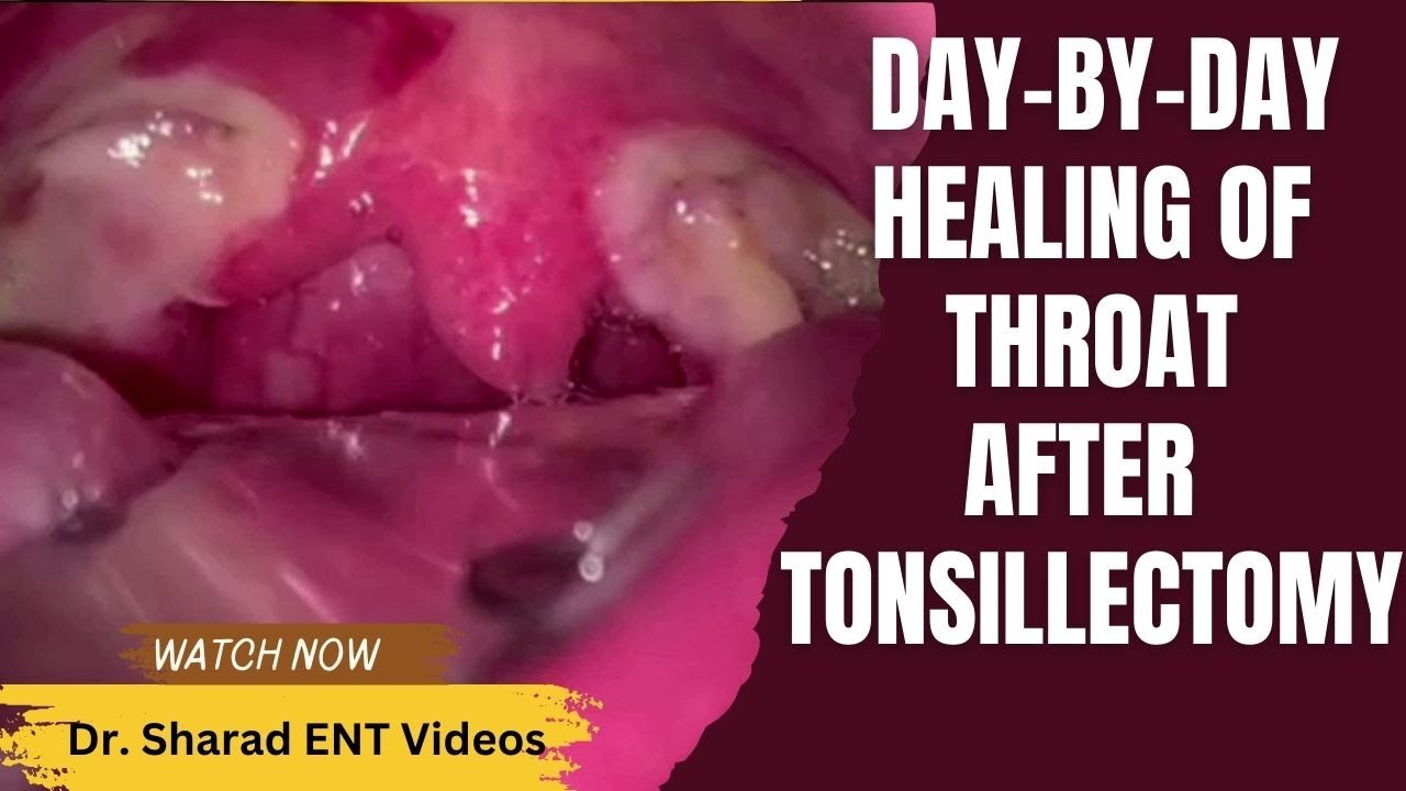 SEE REAL RESULTS: TIME-LAPSE of Healing After Tonsillectomy || Healing ...