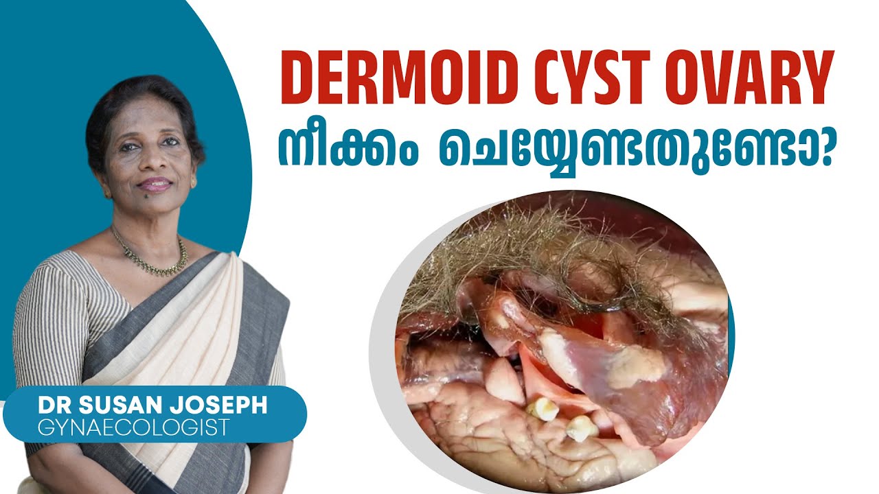 Dermoid cyst ovary - when to operate? | DR.SUSAN JOSEPH - YouTube
