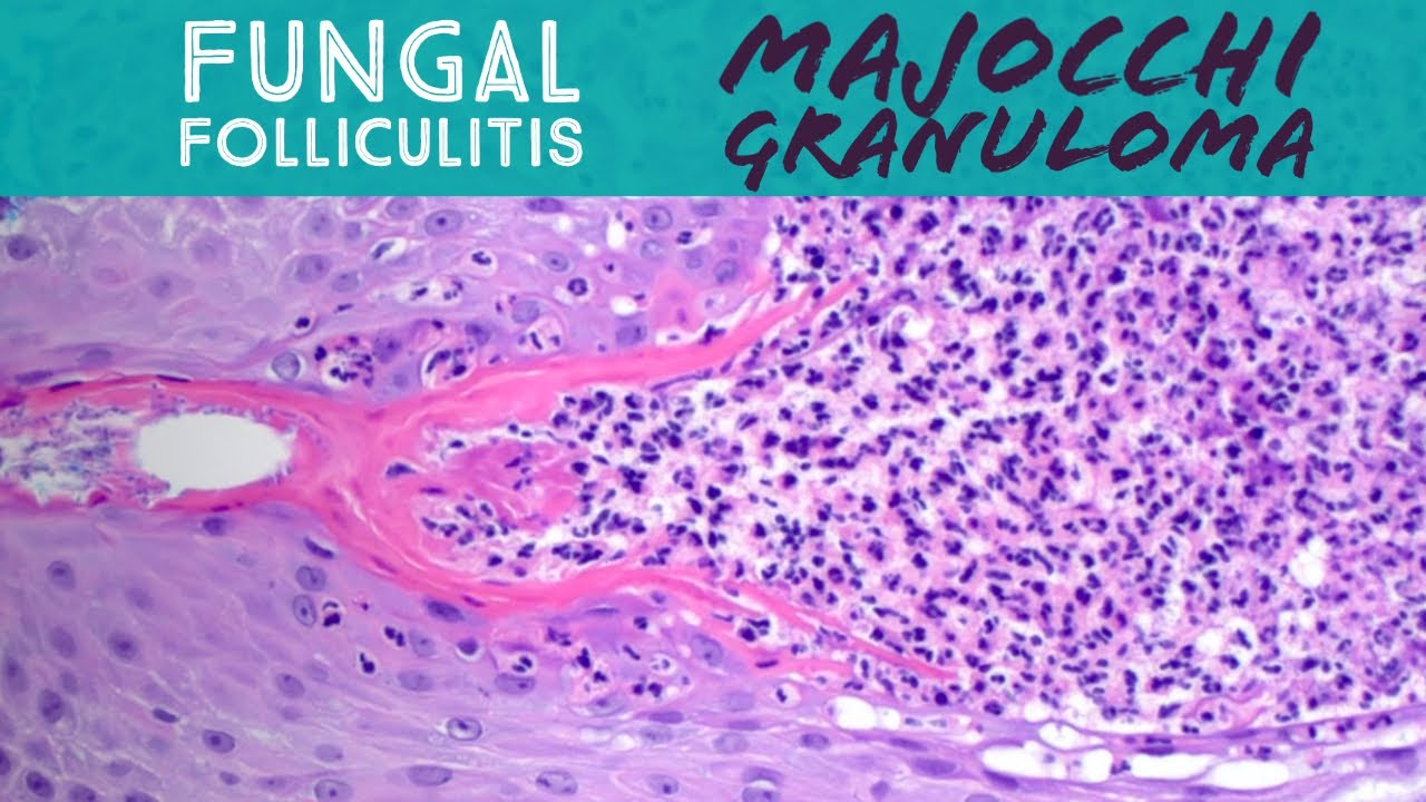 Pityrosporum Folliculitis Histology