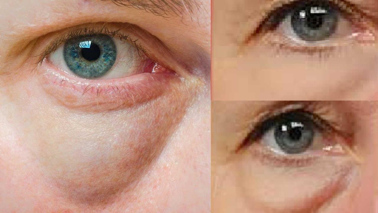 APPLY AT NIGHT WAKE UP WITH CLEAR UNDER EYES, SHRINK EYE BAGS GET RID ...