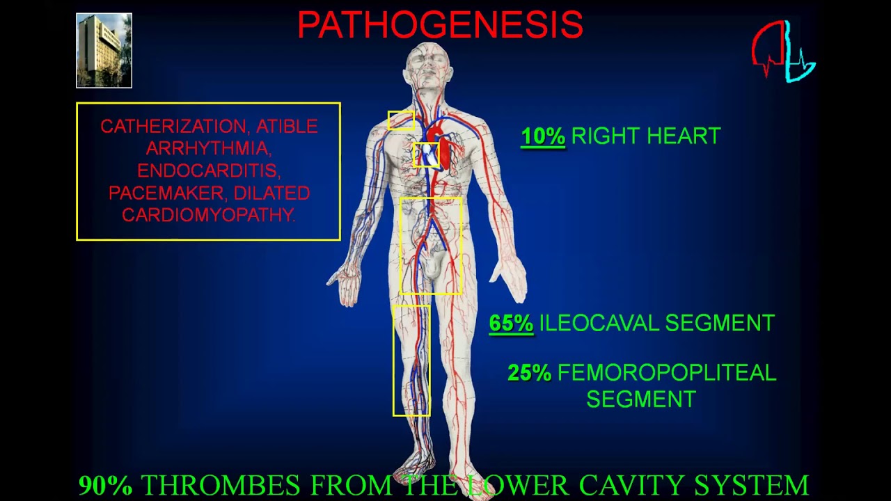 Lung tromboembolism - YouTube