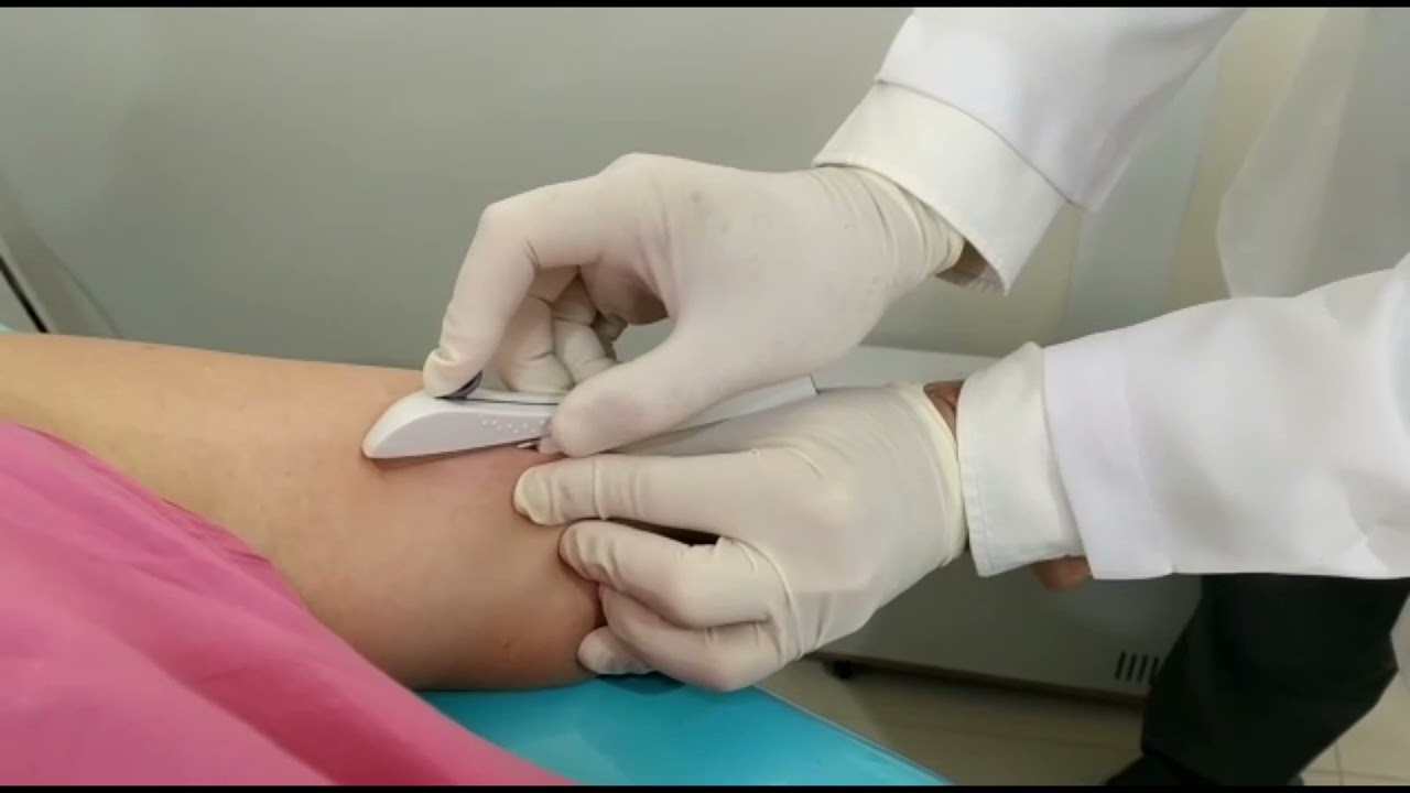 Inserção de Implanon “chip hormonal anticoncepcional “ - YouTube