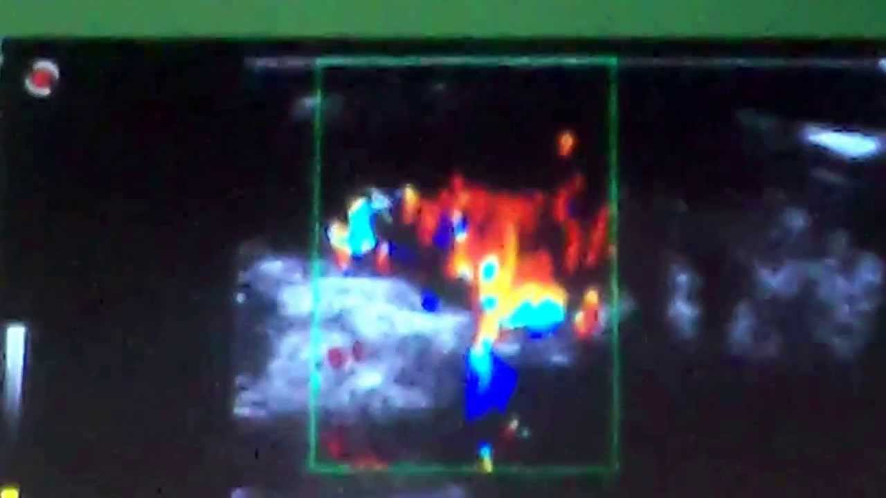 Ecografía cutánea de las úlceras - YouTube