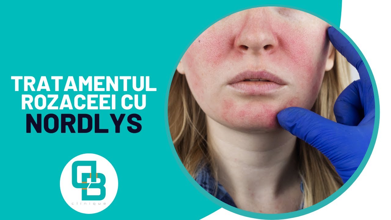 Tratamentul rozaceei cu laserul Nordlys | DermaBeauty Clinique - YouTube