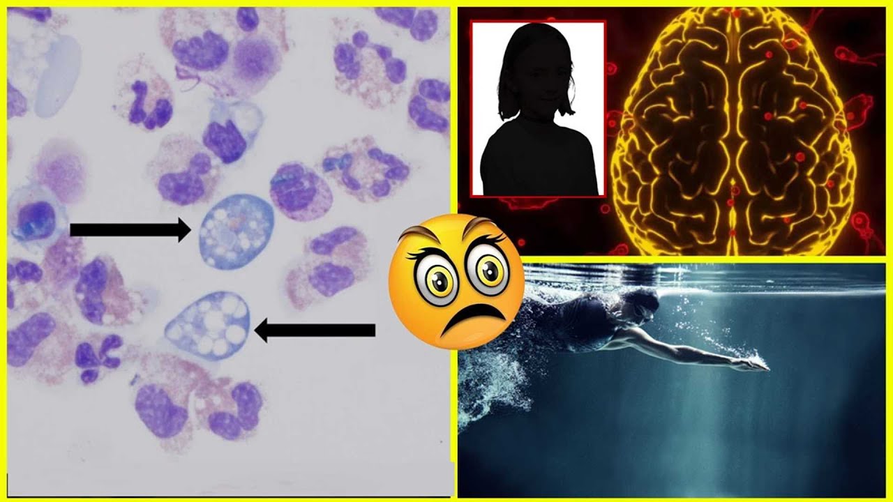 Naegleria Fowleri: The Brain-Eating Amoeba - YouTube