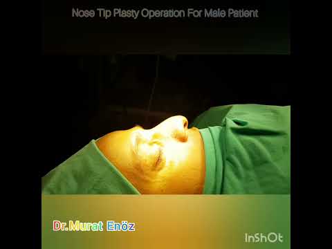 Nose Tip Plasty Operation For Treatment of "Droopy or Ptotic Nasal Tip ...