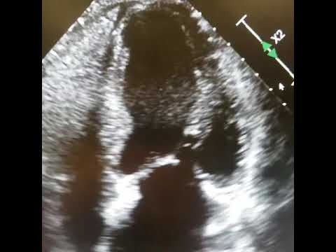 Echocardiography - Apical akinesis - YouTube