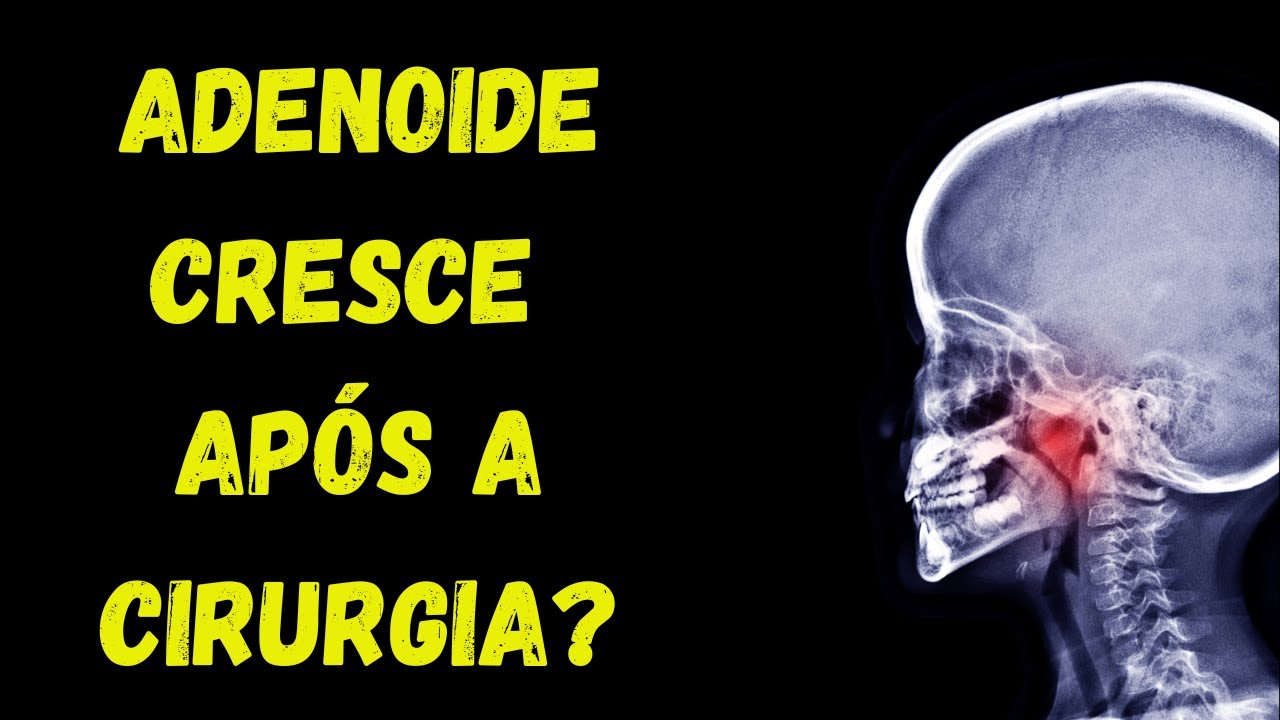 A Adenoide Volta Depois De Ser Operada ? A Carne Esponjosa Do Nariz ...