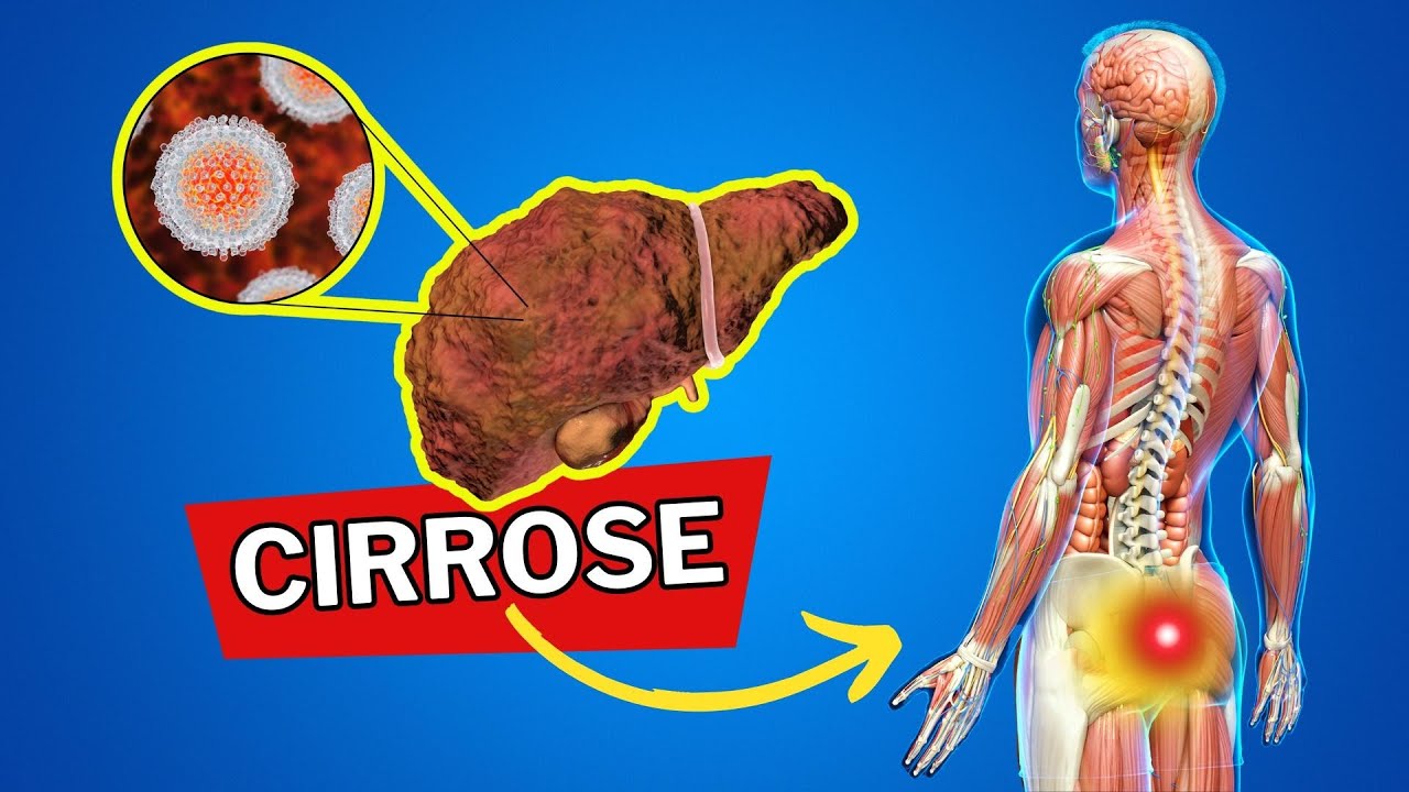 Sinais Iniciais de Cirrose Hepática: O que Você Precisa Saber! - YouTube