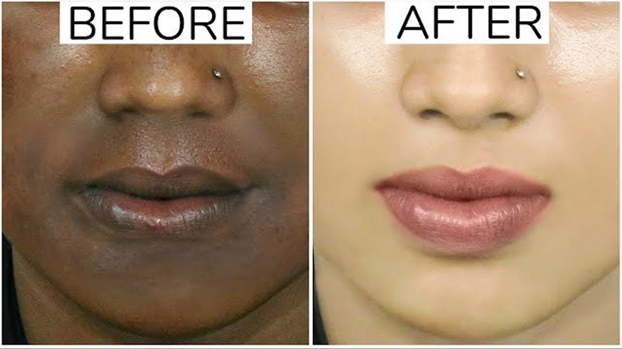 Top 2 Serum for Urgent Face whitening and Acne | Get Whitening face ...