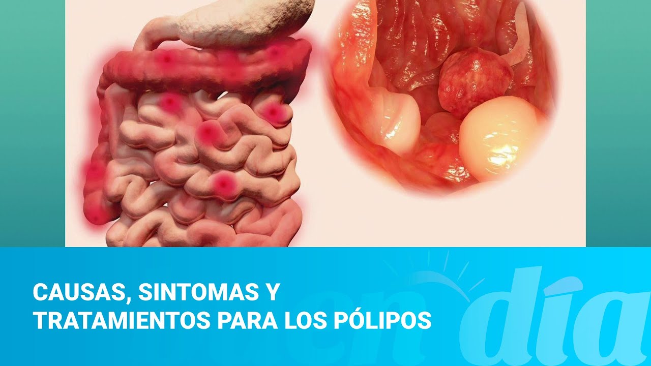 Causas, sintomas y tratamientos para los pólipos - YouTube